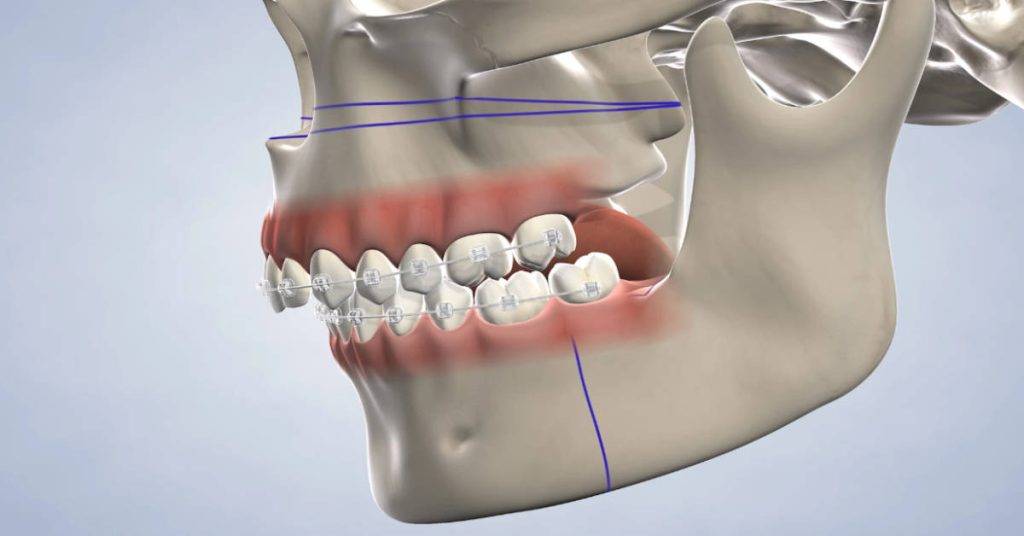 Orthognathic (JAW) Surgery - Kreative Dentistry